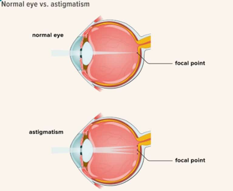 Astigmatism - Harley Vision